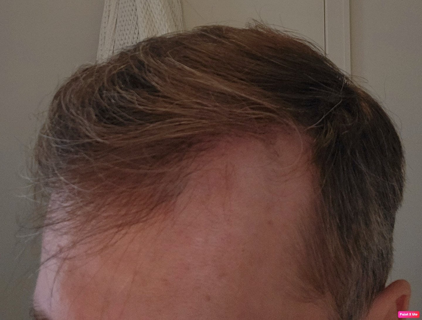 Dr Michael Wolfeld (NYC) review - Hair Restoration Questions and ...