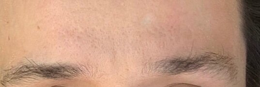 Temporal peaks design - Hair Restoration Questions and Answers - Hair ...