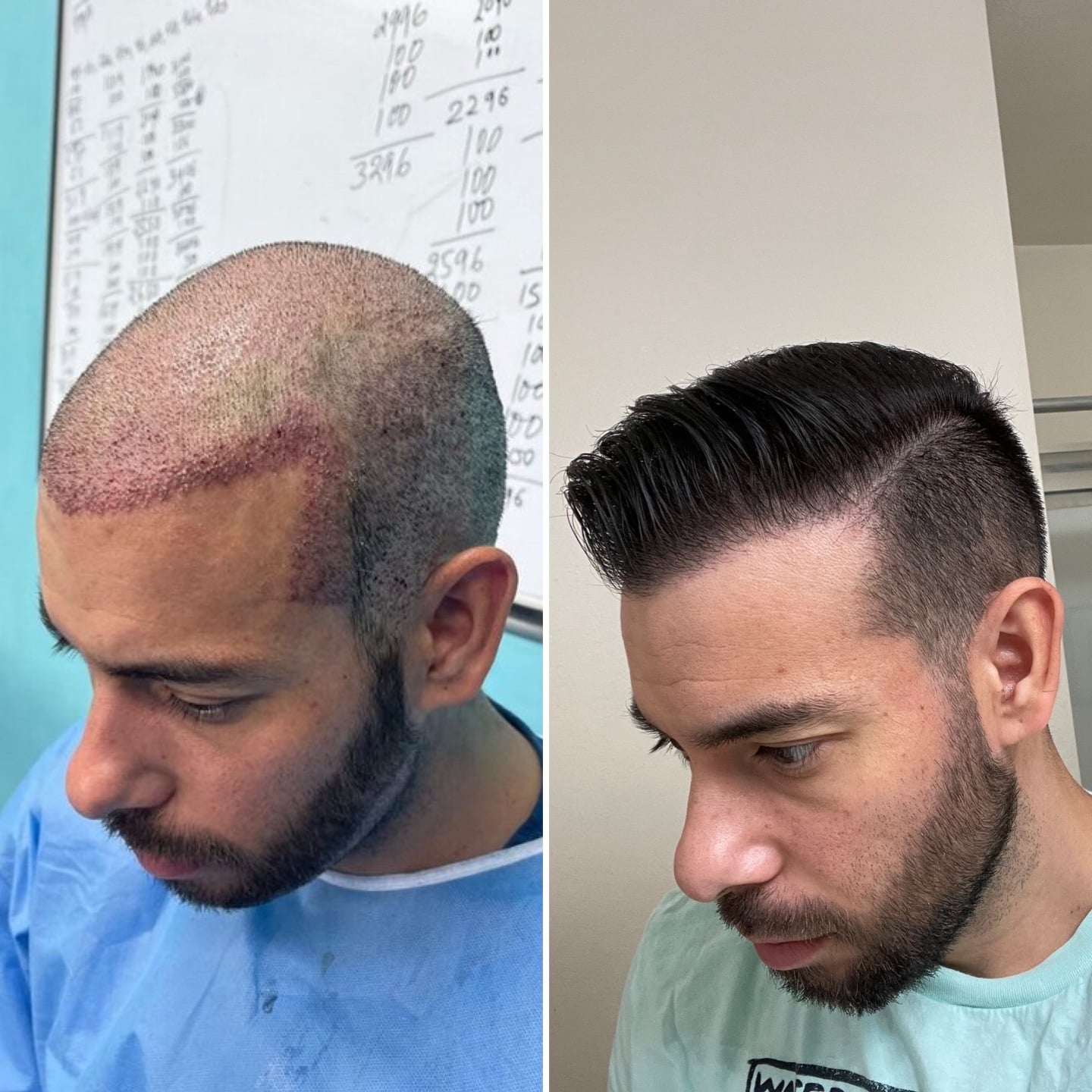 Temporal peaks design - Hair Restoration Questions and Answers - Hair ...