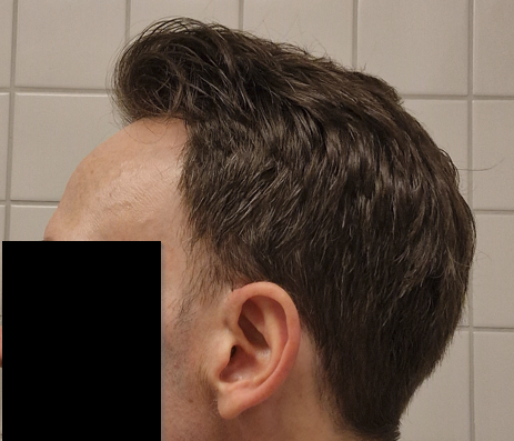 Ensure good result in temporal points in Europe - Hair Restoration ...