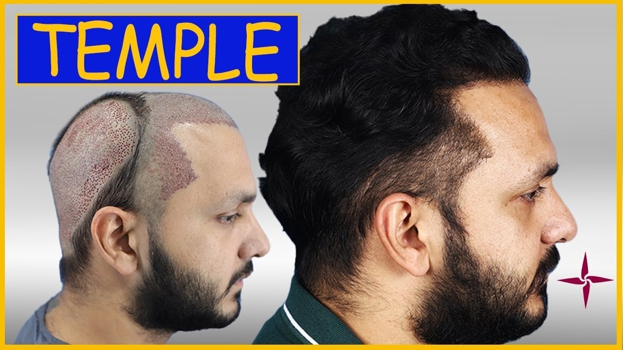 Temporal peaks design - Hair Restoration Questions and Answers - Hair ...