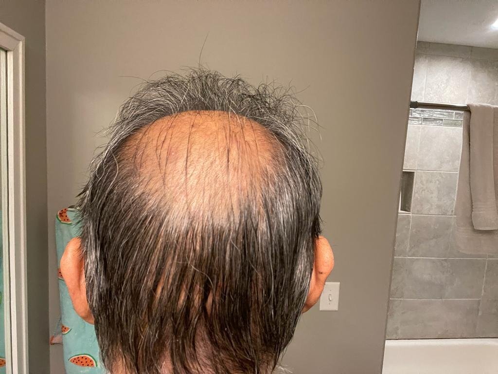 Choosing a clinic for BHT to Scalp in India - Hair Restoration ...