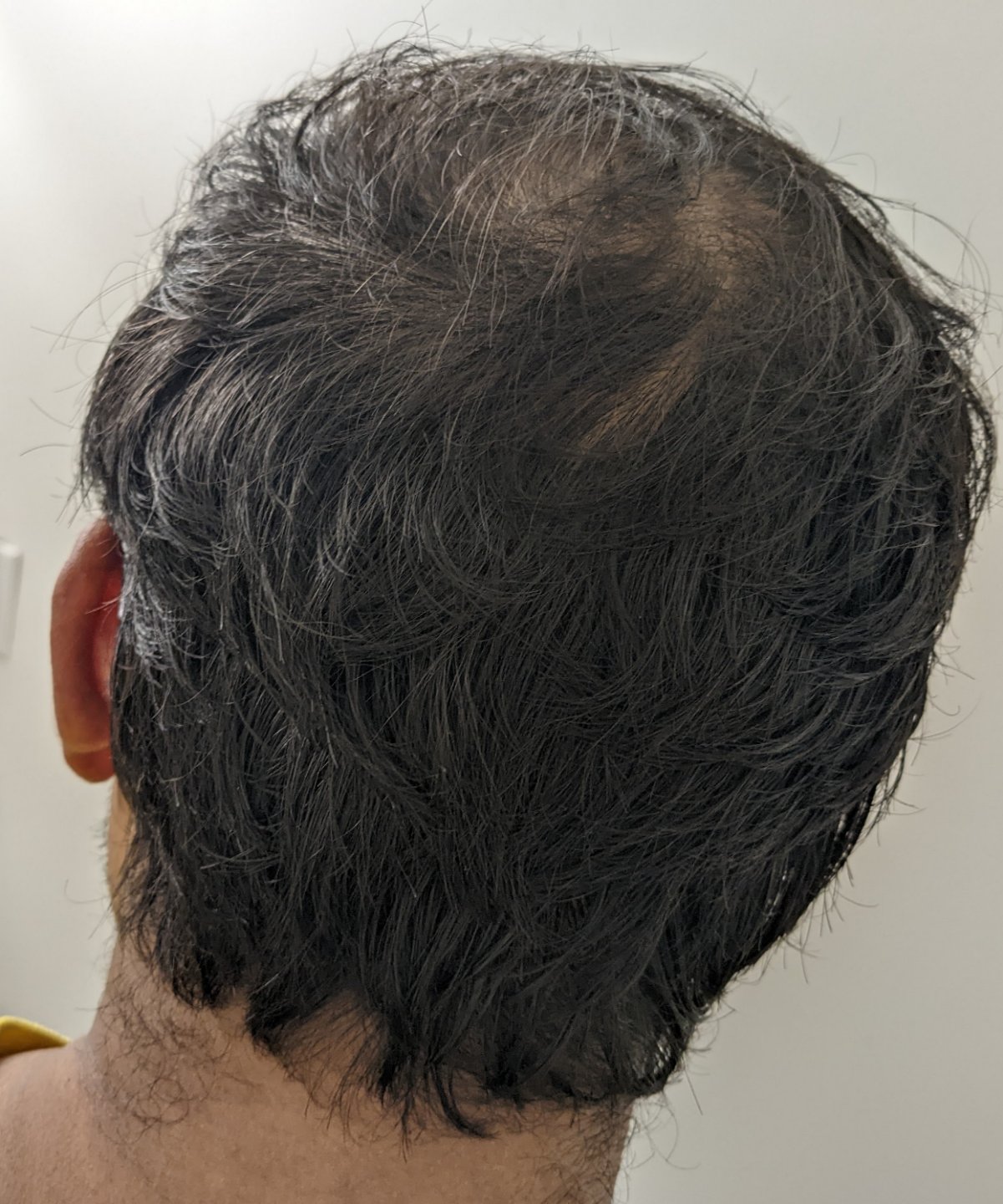 What scale is my hair loss? - Hair Restoration Questions and Answers ...