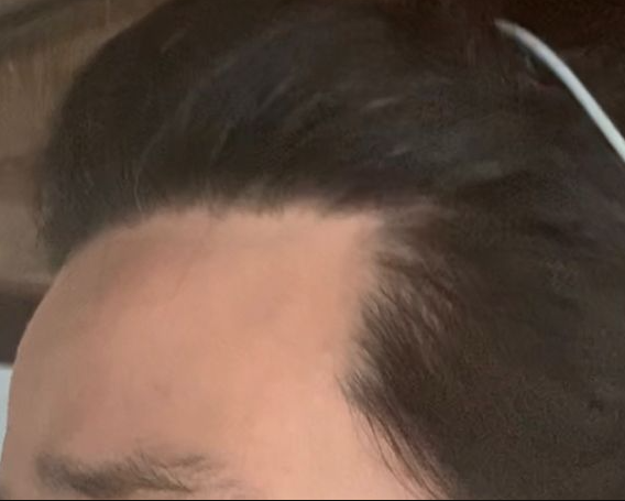 Ensure good result in temporal points in Europe - Hair Restoration ...