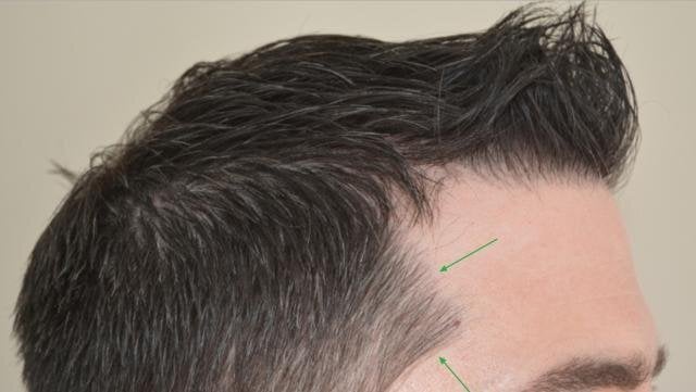 Temporal peaks design - Page 2 - Hair Restoration Questions and Answers ...