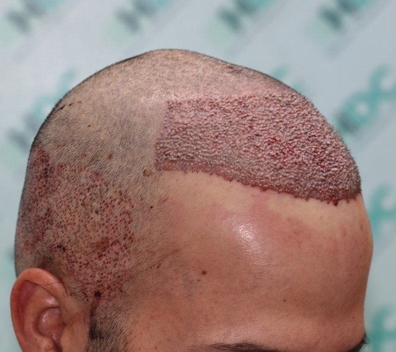 Result of 4000 Dense grafts – 1 year after – HDC Hair Clinic – Dr Maras ...