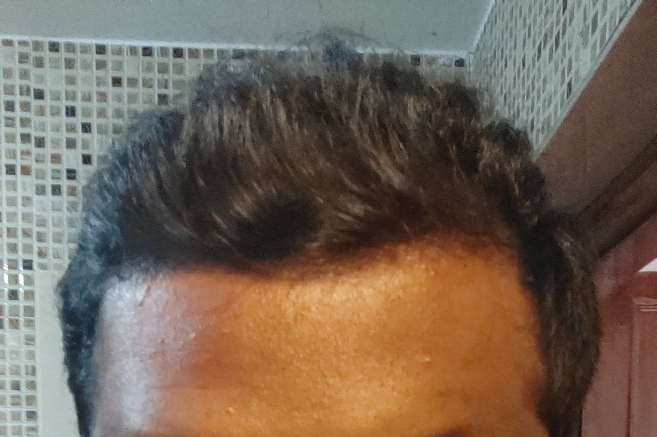 25M facing aggressive hair thinning - Hair Restoration Questions and ...