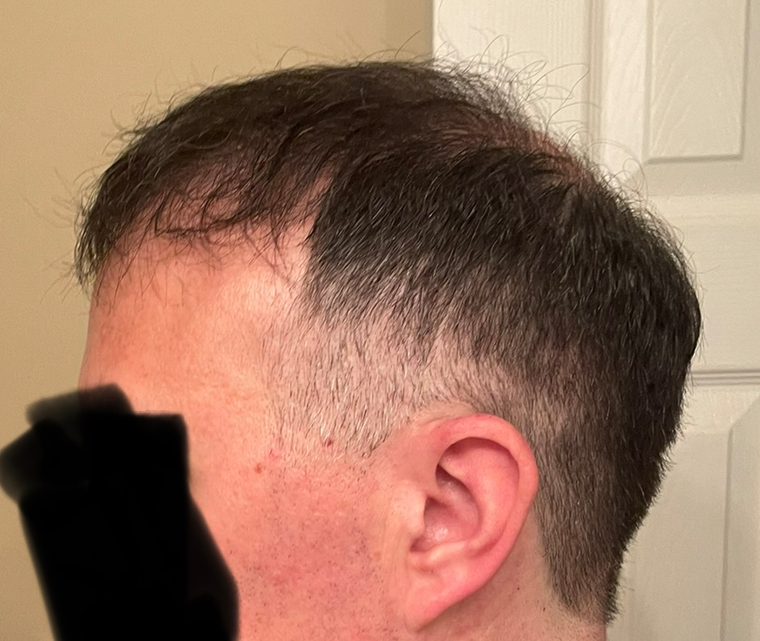 Your perspective on Dr. Kayihan Sahinoglu (TR)? - Hair Transplant ...