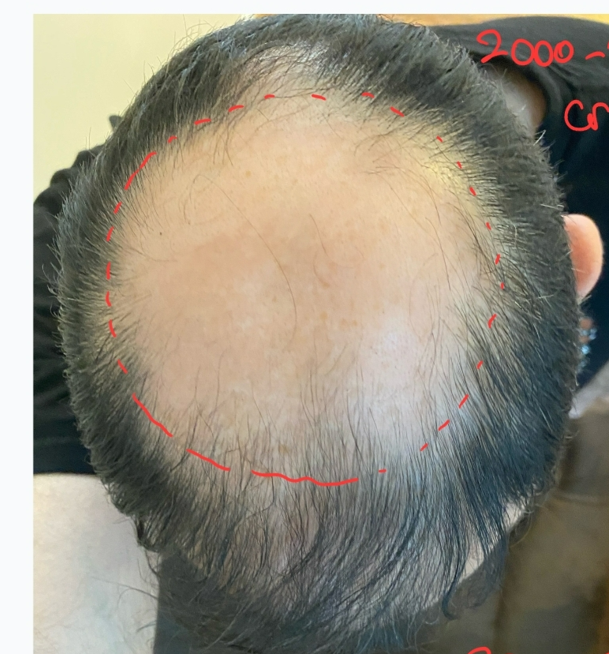 Your perspective on Dr. Kayihan Sahinoglu (TR)? - Hair Transplant ...