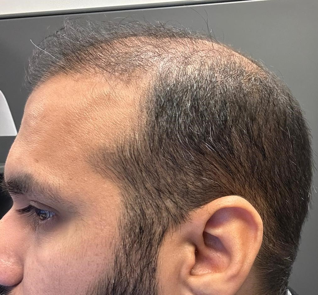 Eugenix- Nov 16, 2022- Dr. Arika Bansal- 3500 grafts- 35M- NW6 - Page 5 ...