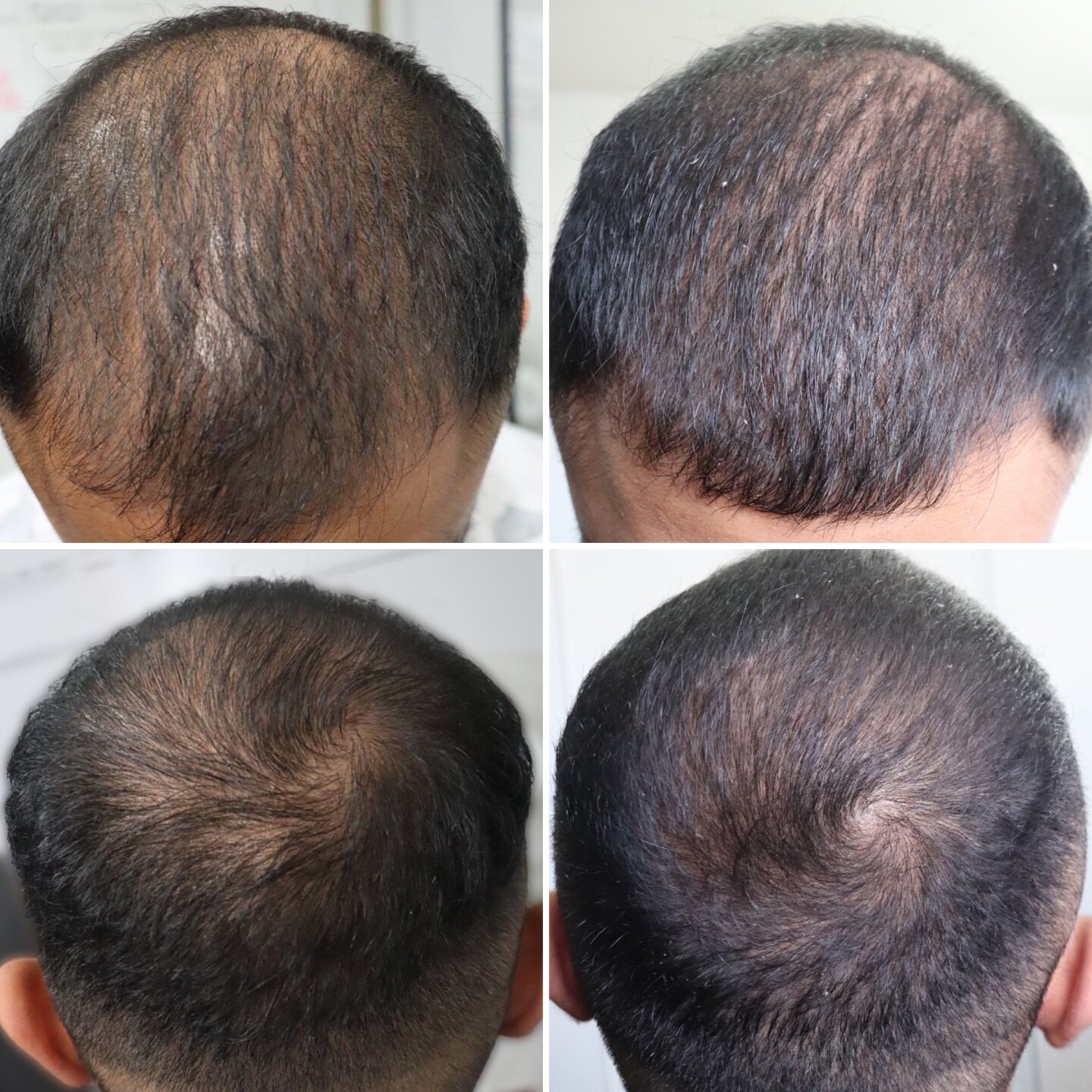 XYON and Minoxidil 12 Months of Topical Journey – NW 3 - Hair Loss ...