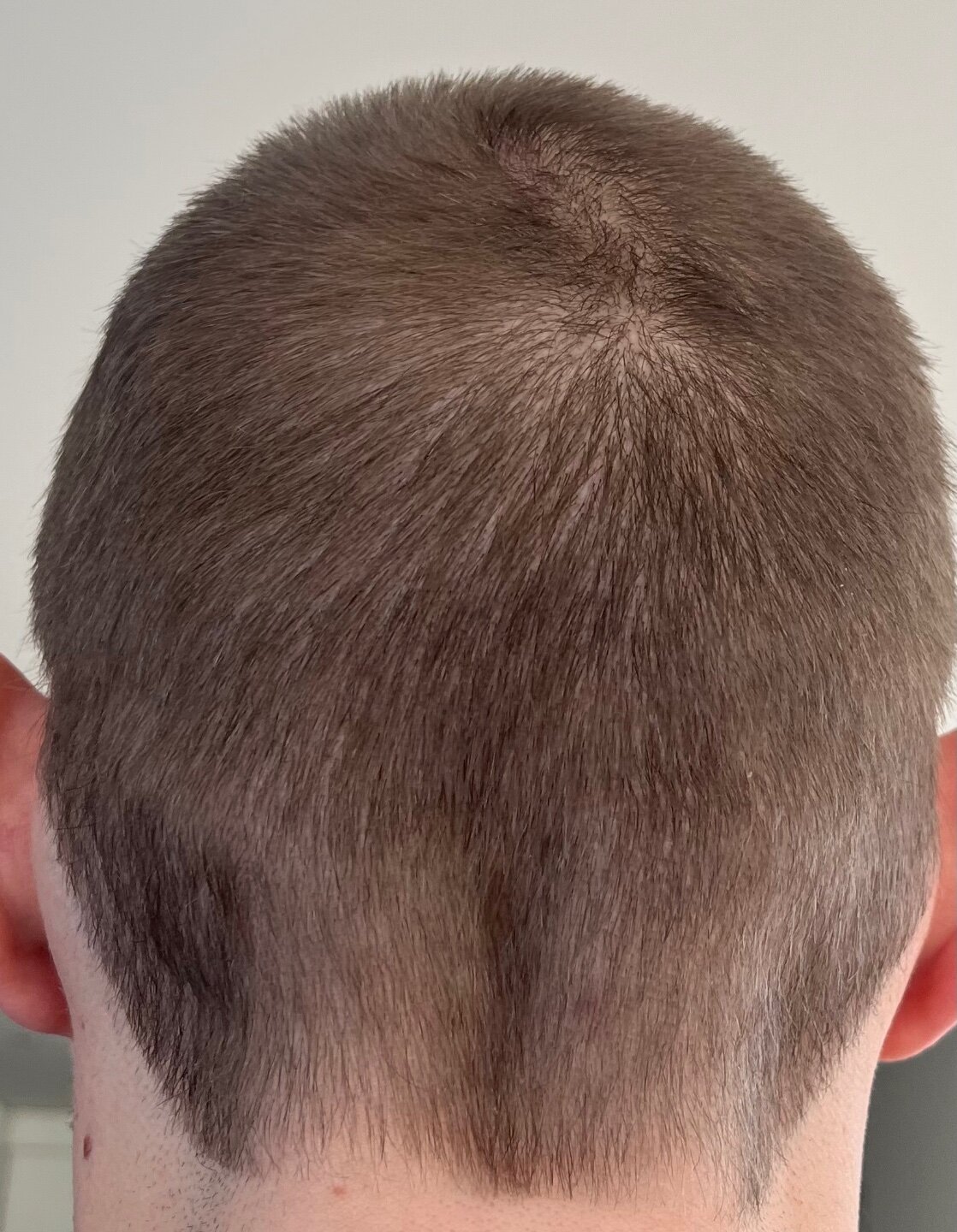 Best surgeon for straight hairline ? - Hair Restoration Questions and ...