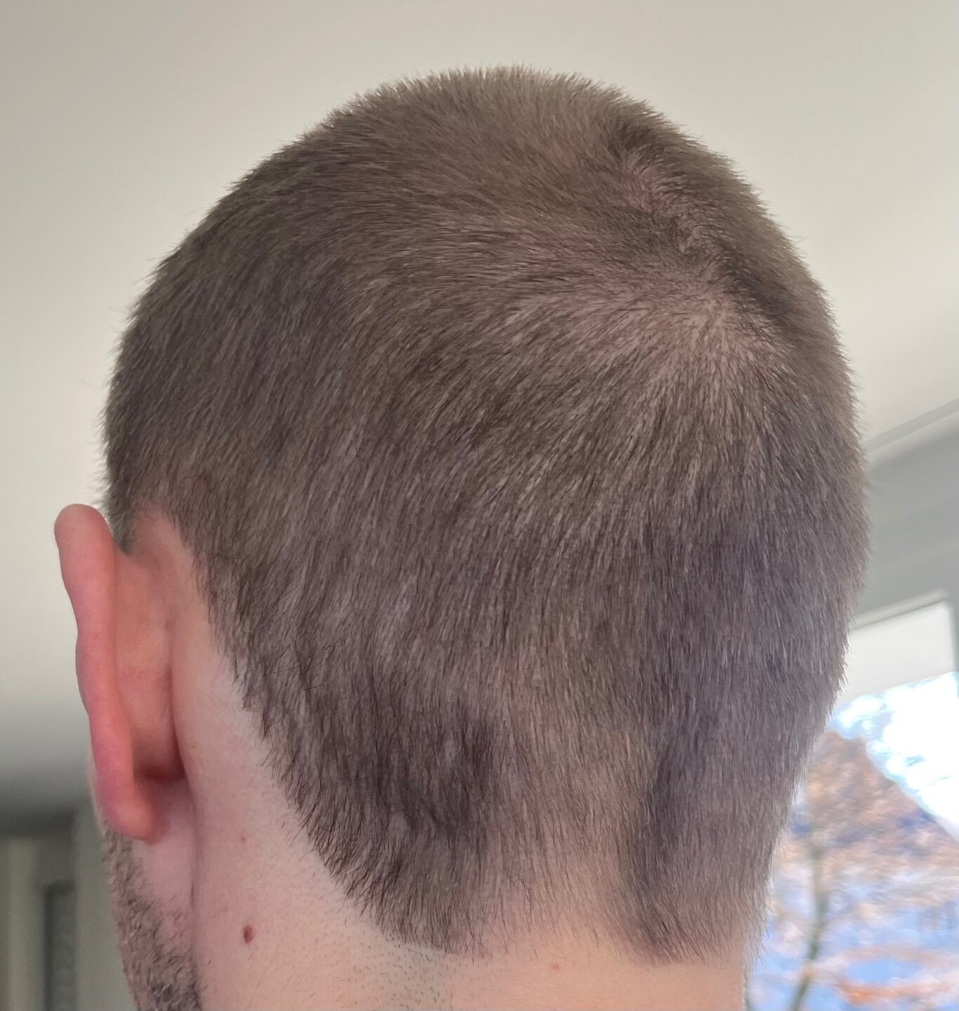 Best surgeon for straight hairline ? - Hair Restoration Questions and ...