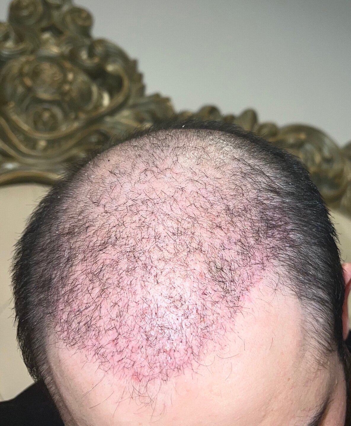 Day 34 - Does everything look Normal? - Hair Restoration Questions and ...