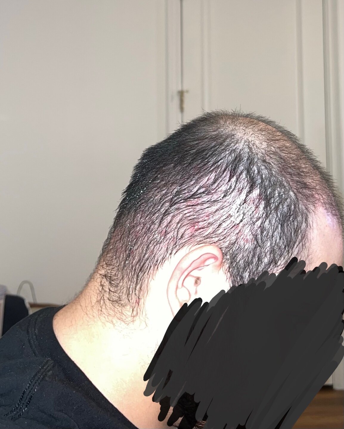 Day 34 - Does everything look Normal? - Hair Restoration Questions and ...