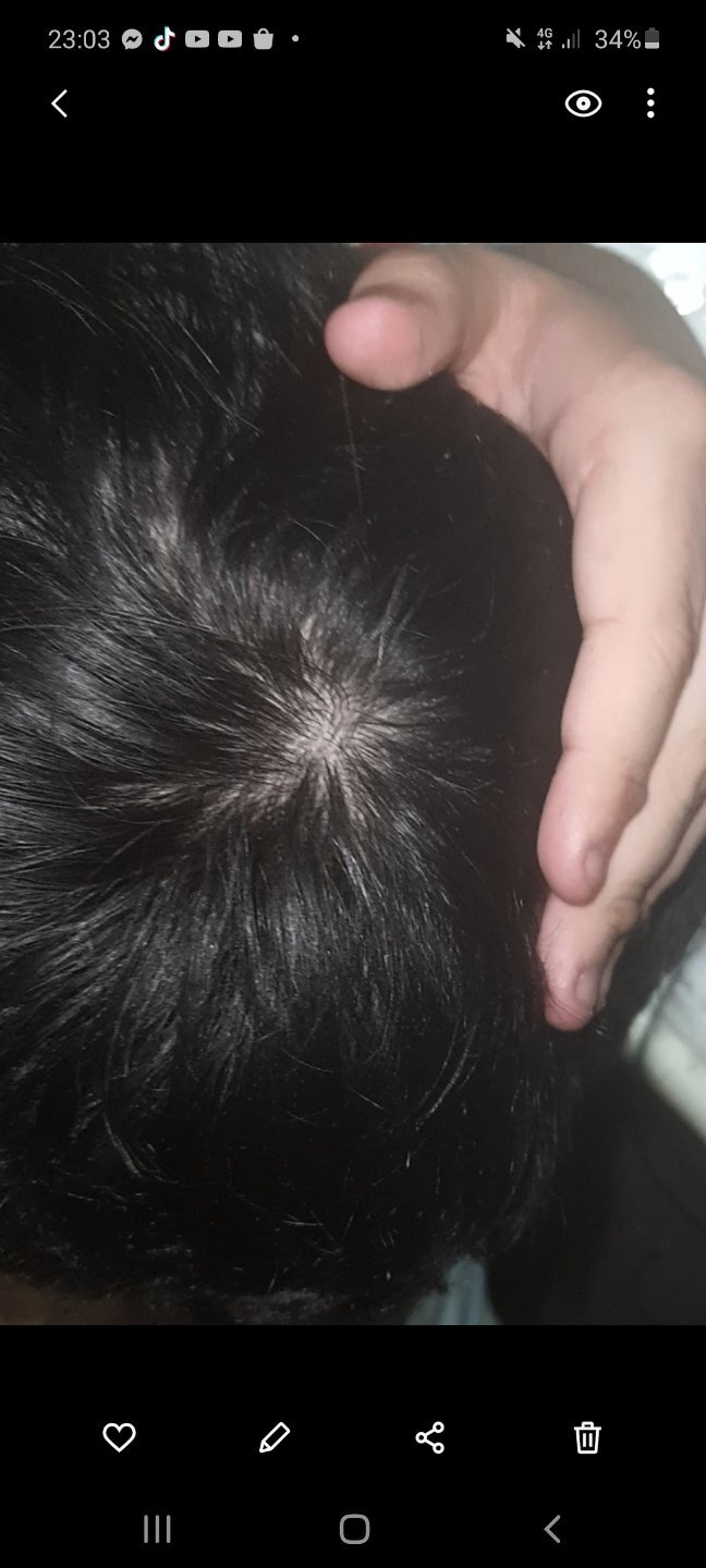bald vertex? - Hair Restoration Questions and Answers - Hair ...