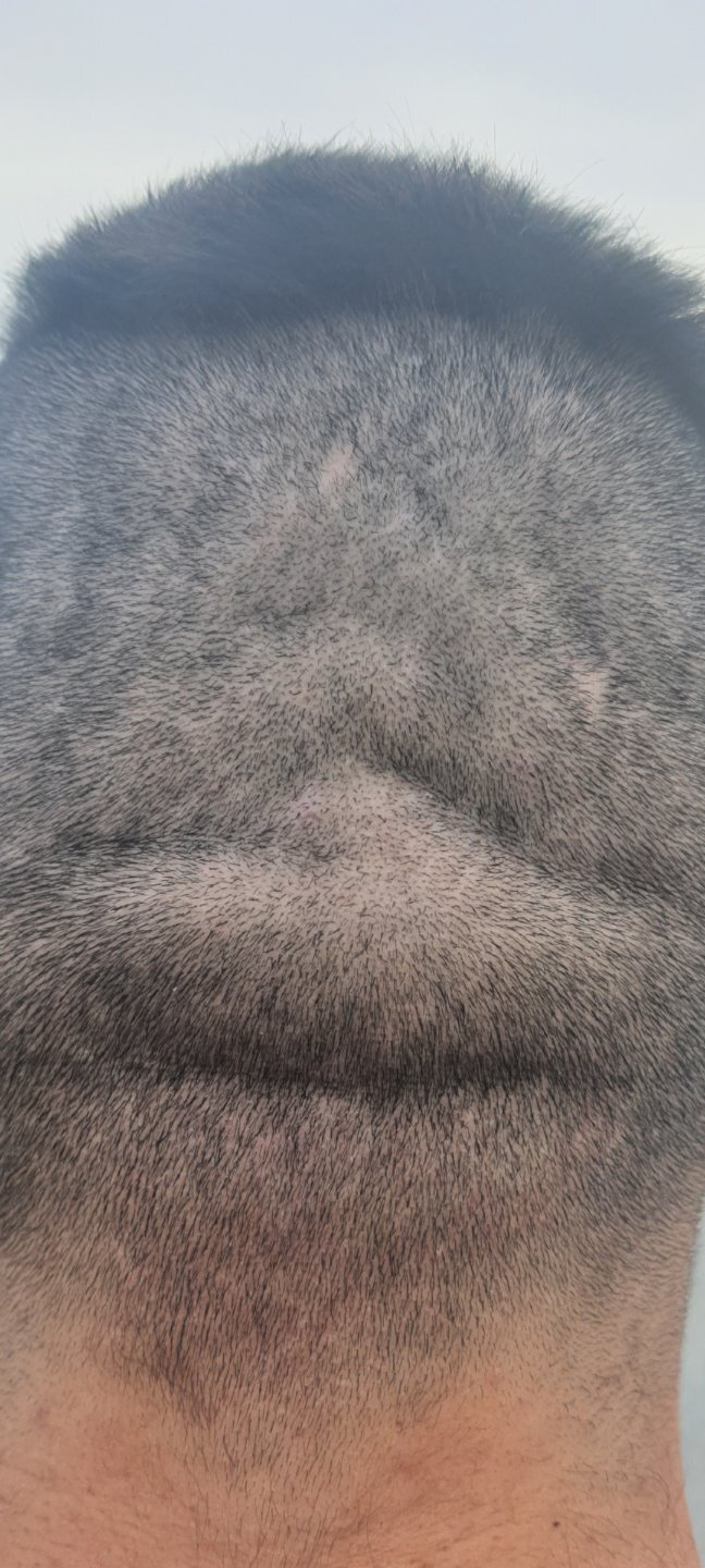 bald vertex? - Hair Restoration Questions and Answers - Hair ...