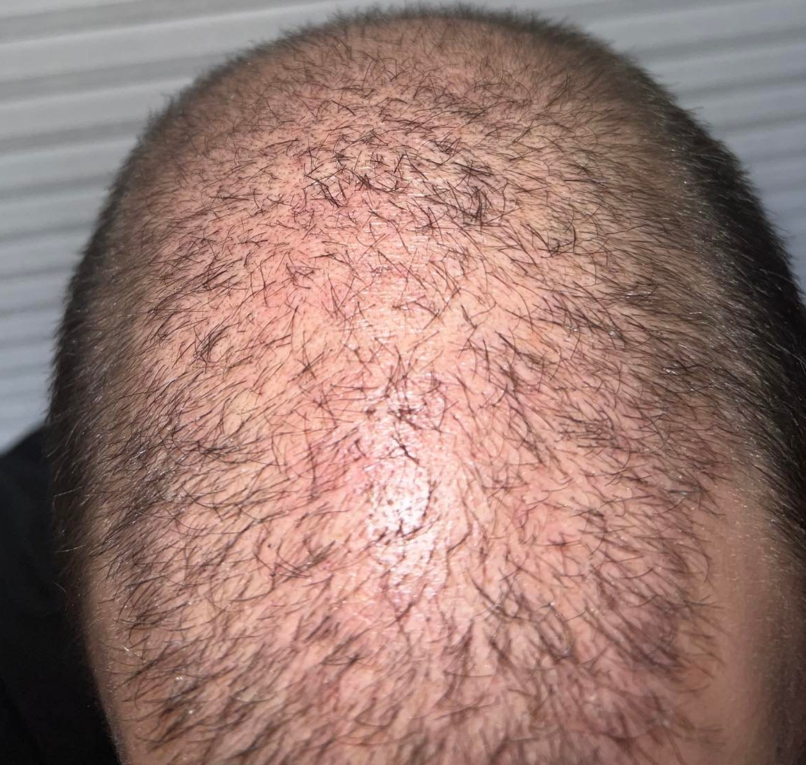 FUT 2901 Grafts by Dr. Steven Gabel 6/2/2016 - Hair Transplant Reviews ...