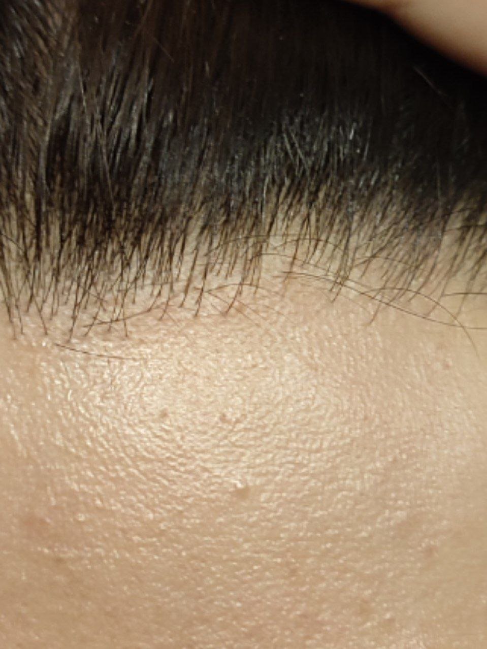 Starting to see minor recession around temples. Looking for advice ...