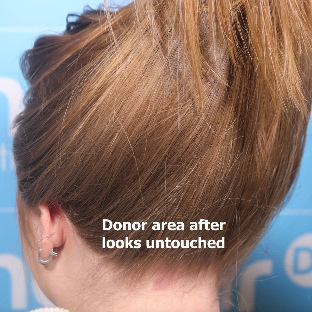 Traumatic alopecia patch in frontal female hairline - Dr Arshad FUE ...