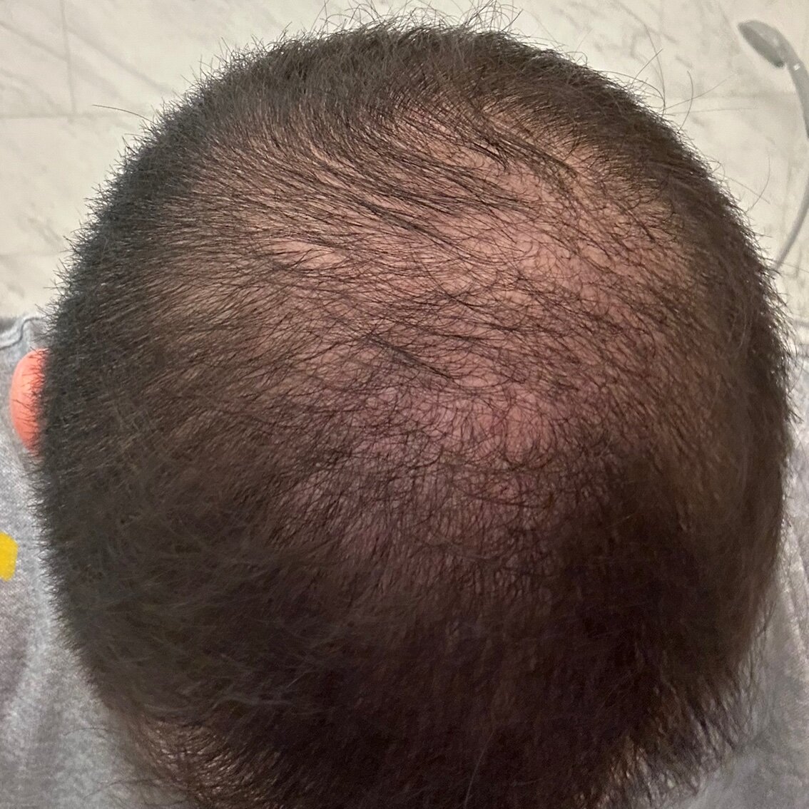 Crown Growth - Hair Restoration Questions and Answers - Hair ...