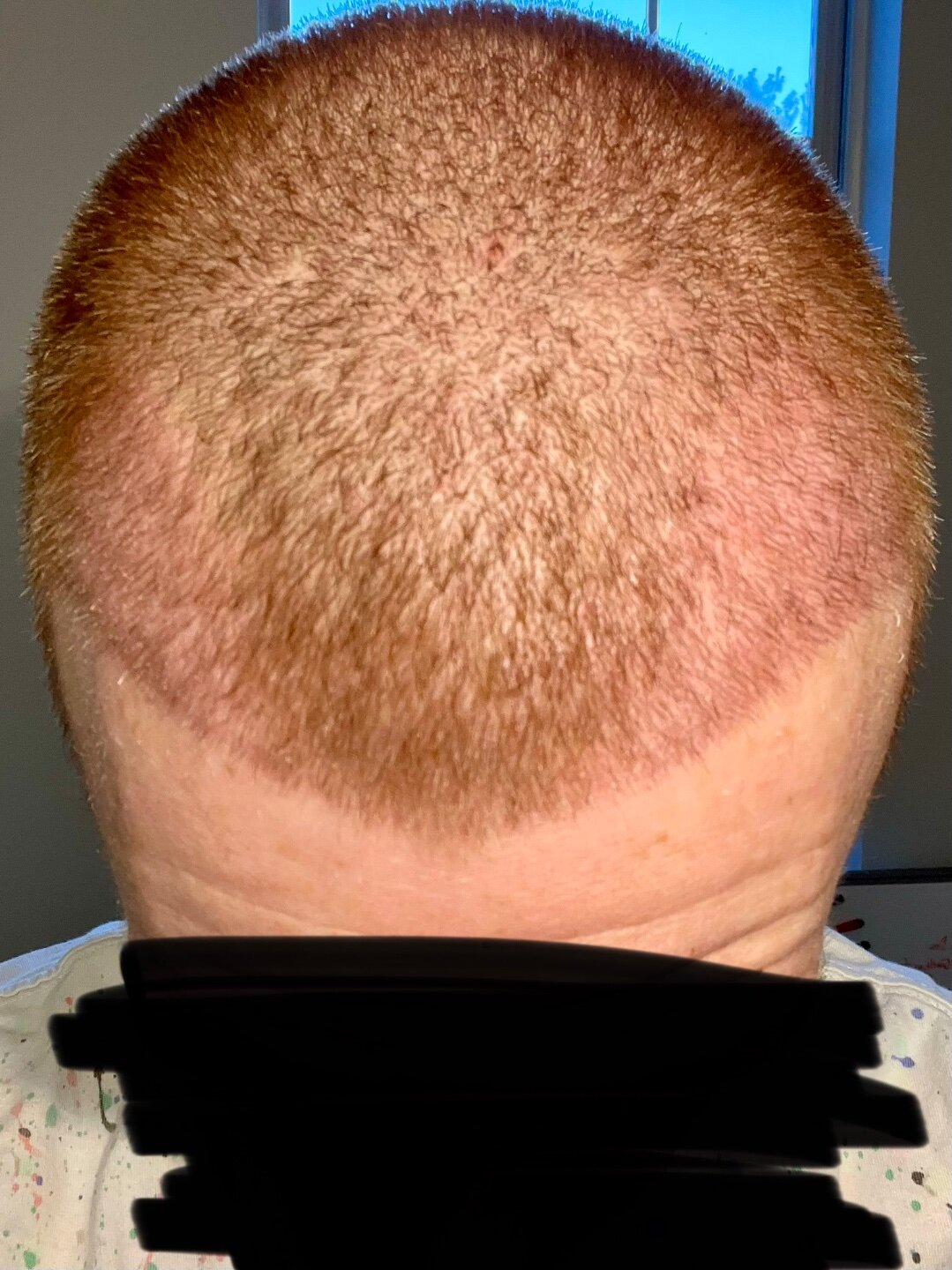 3,000 grafts FUE - Hairline, NW 3 - Camacho / Pareja - Hair Transplant ...