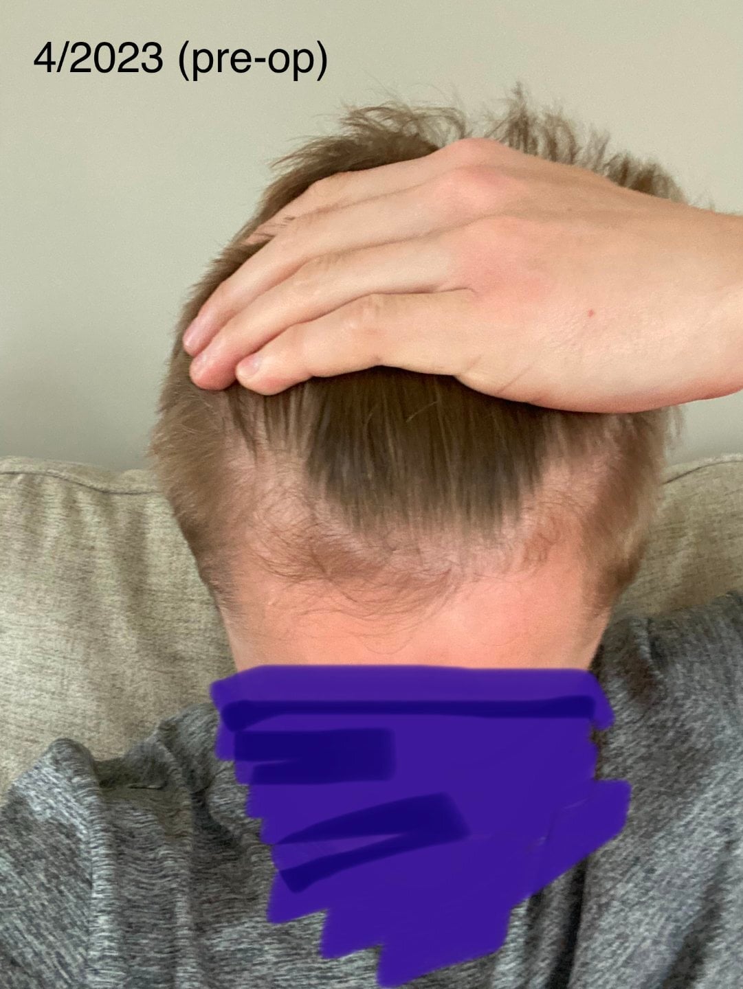 Small but ‘fairly aggressive’ hairline restoration | 901 grafts FUE | 4 ...