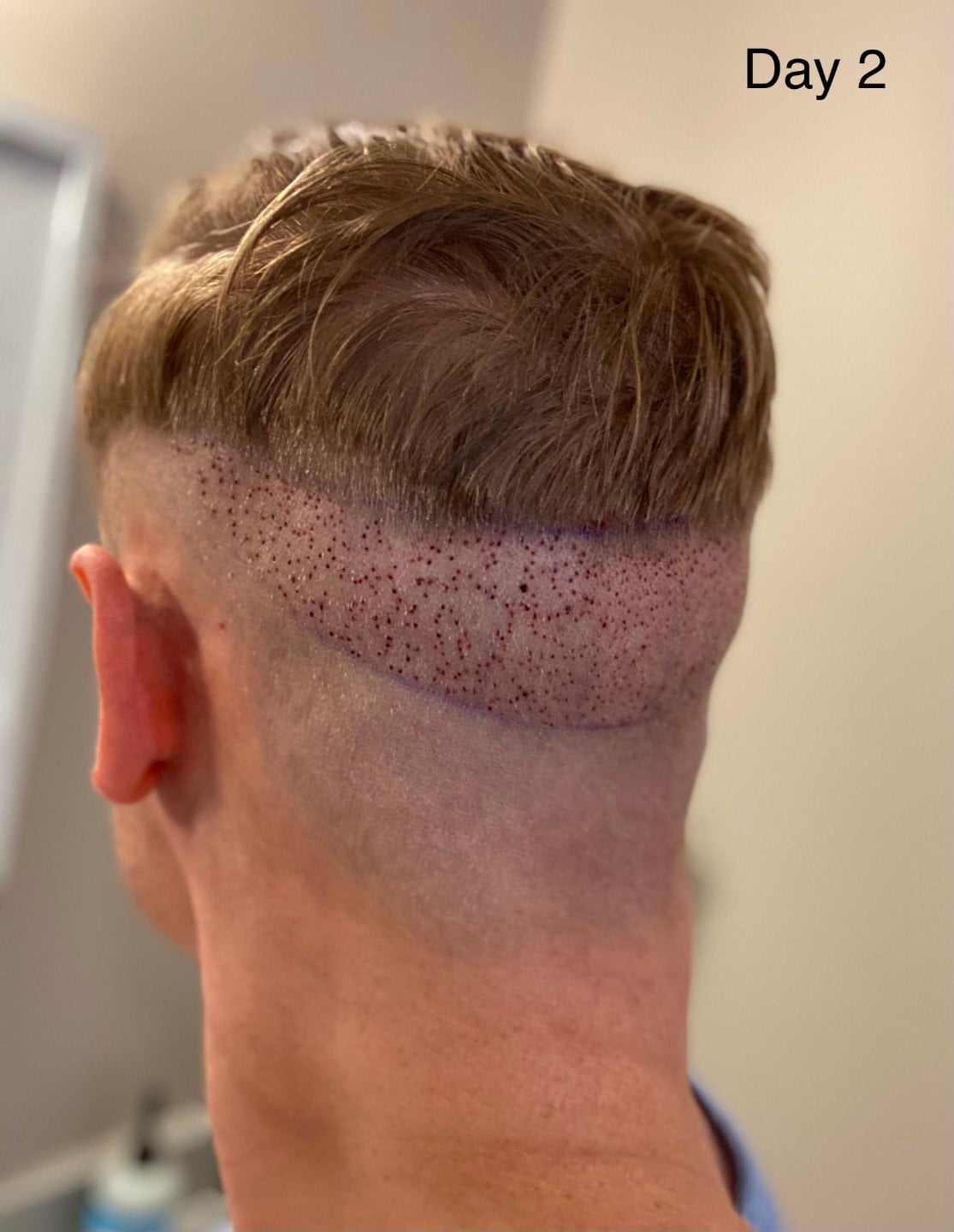 Small but ‘fairly aggressive’ hairline restoration | 901 grafts FUE | 4 ...