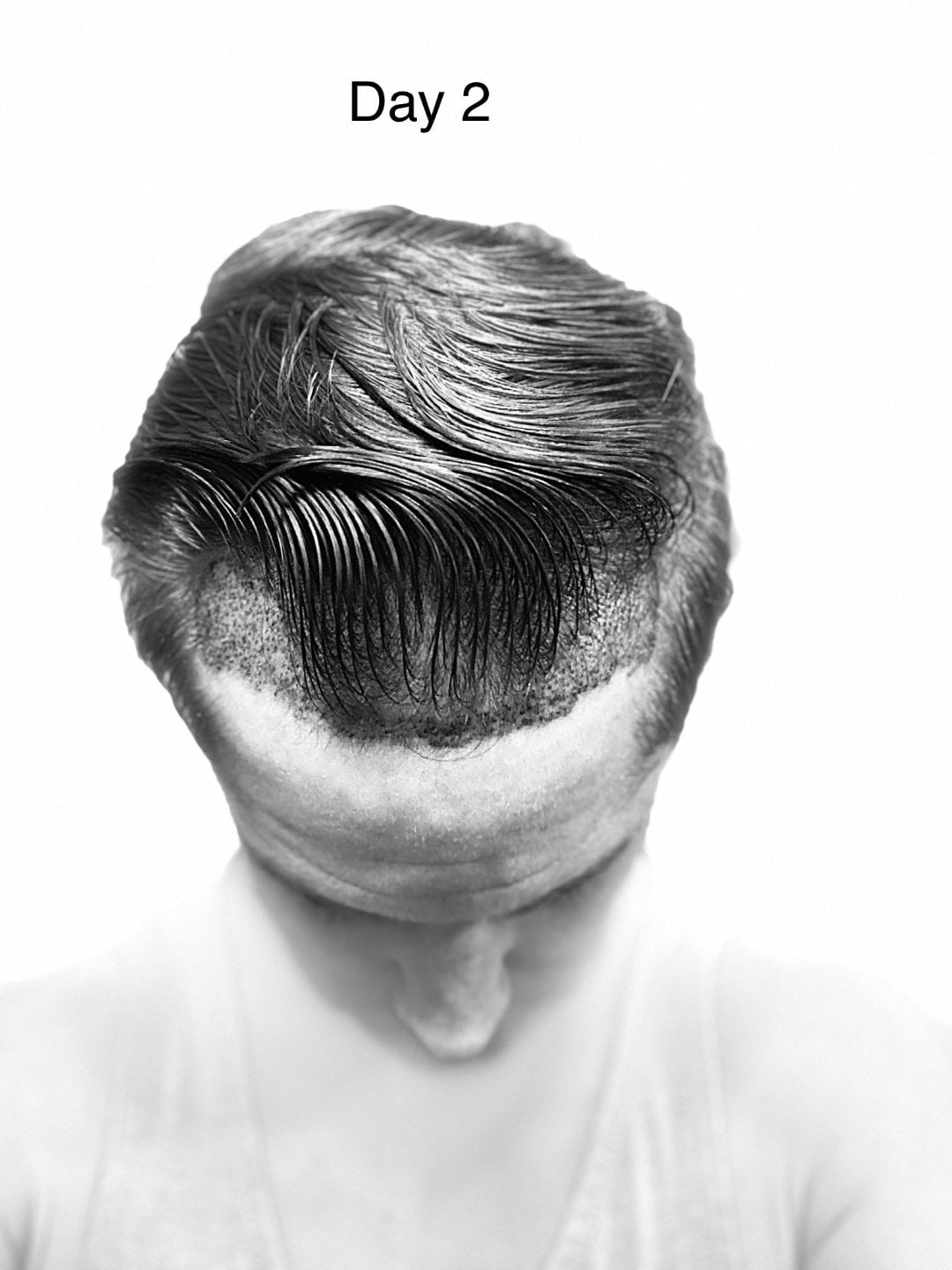 Small but ‘fairly aggressive’ hairline restoration | 901 grafts FUE | 4 ...