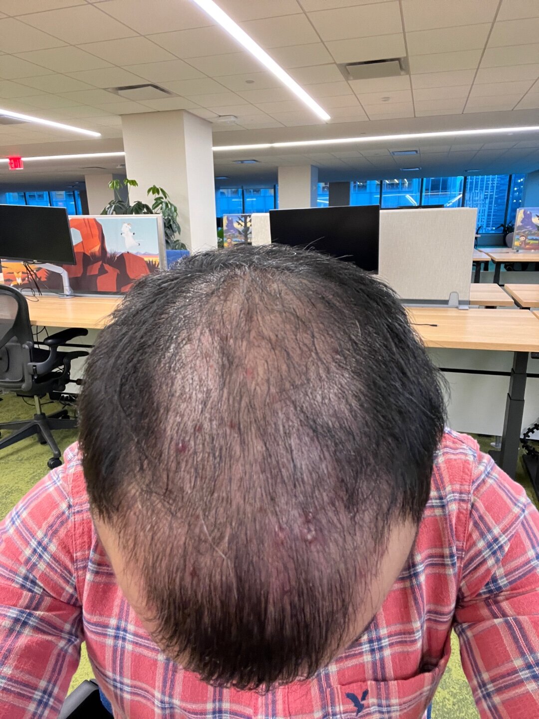 Recommendation on the hairline - Hair Restoration Questions and Answers ...
