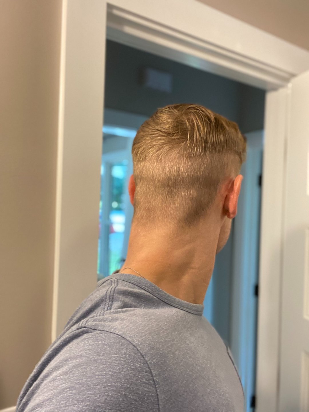 Small but ‘fairly aggressive’ hairline restoration | 901 grafts FUE | 4 ...