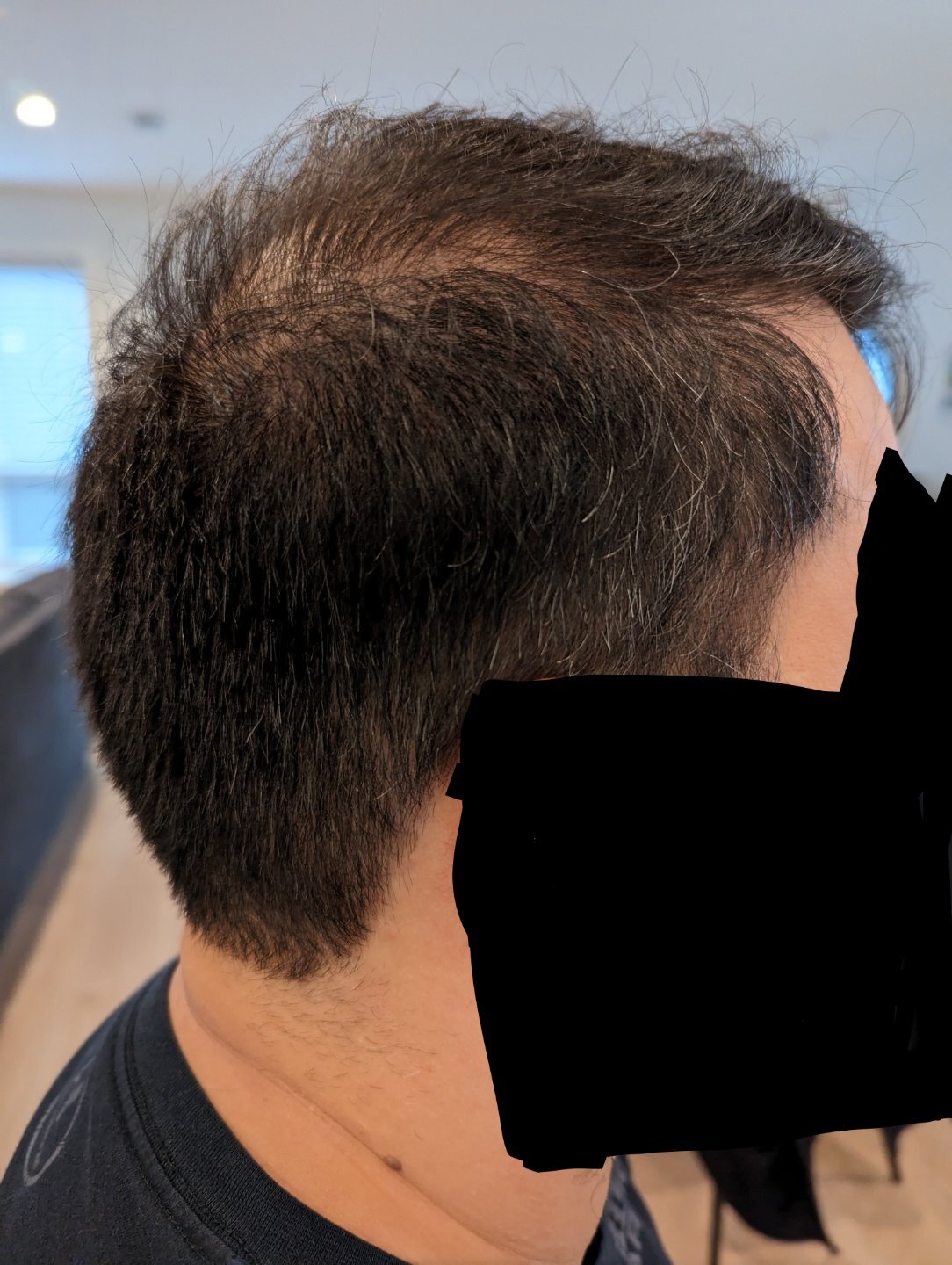 Potential Hair transplant evaluation from current hair condition. (with ...