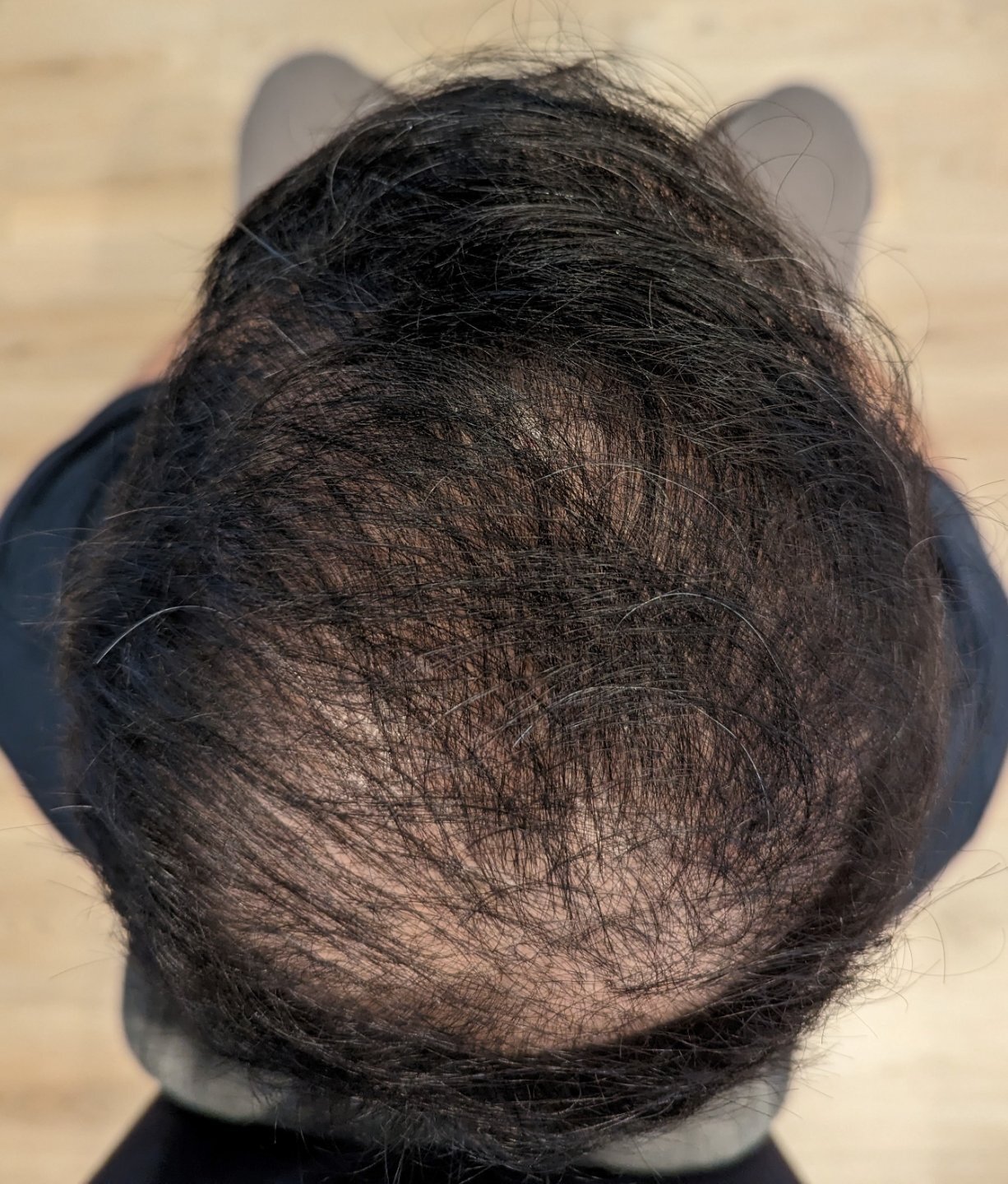 Potential Hair transplant evaluation from current hair condition. (with ...