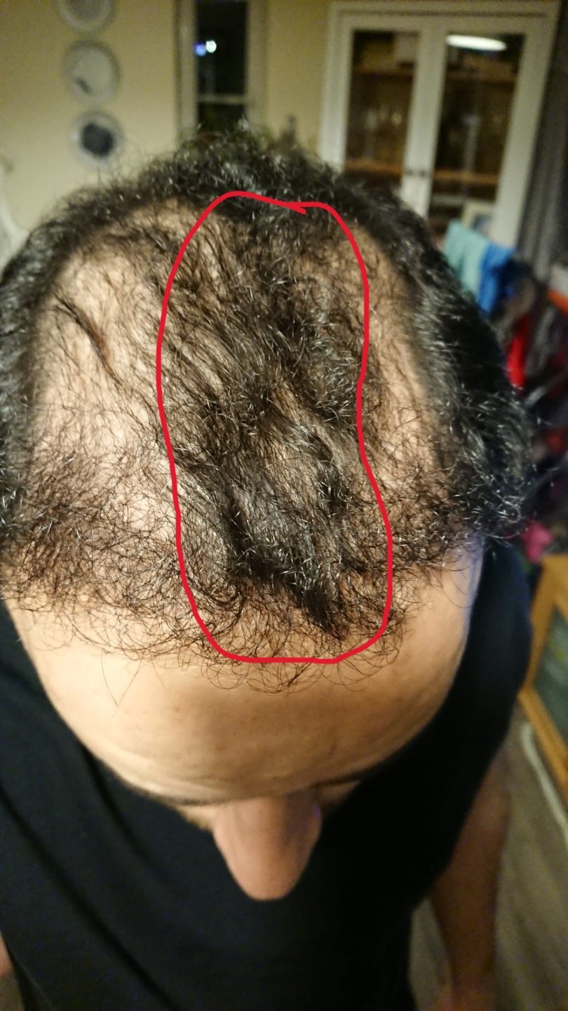 Hair transplant Advice/Recommendation. - Hair Restoration Questions and ...