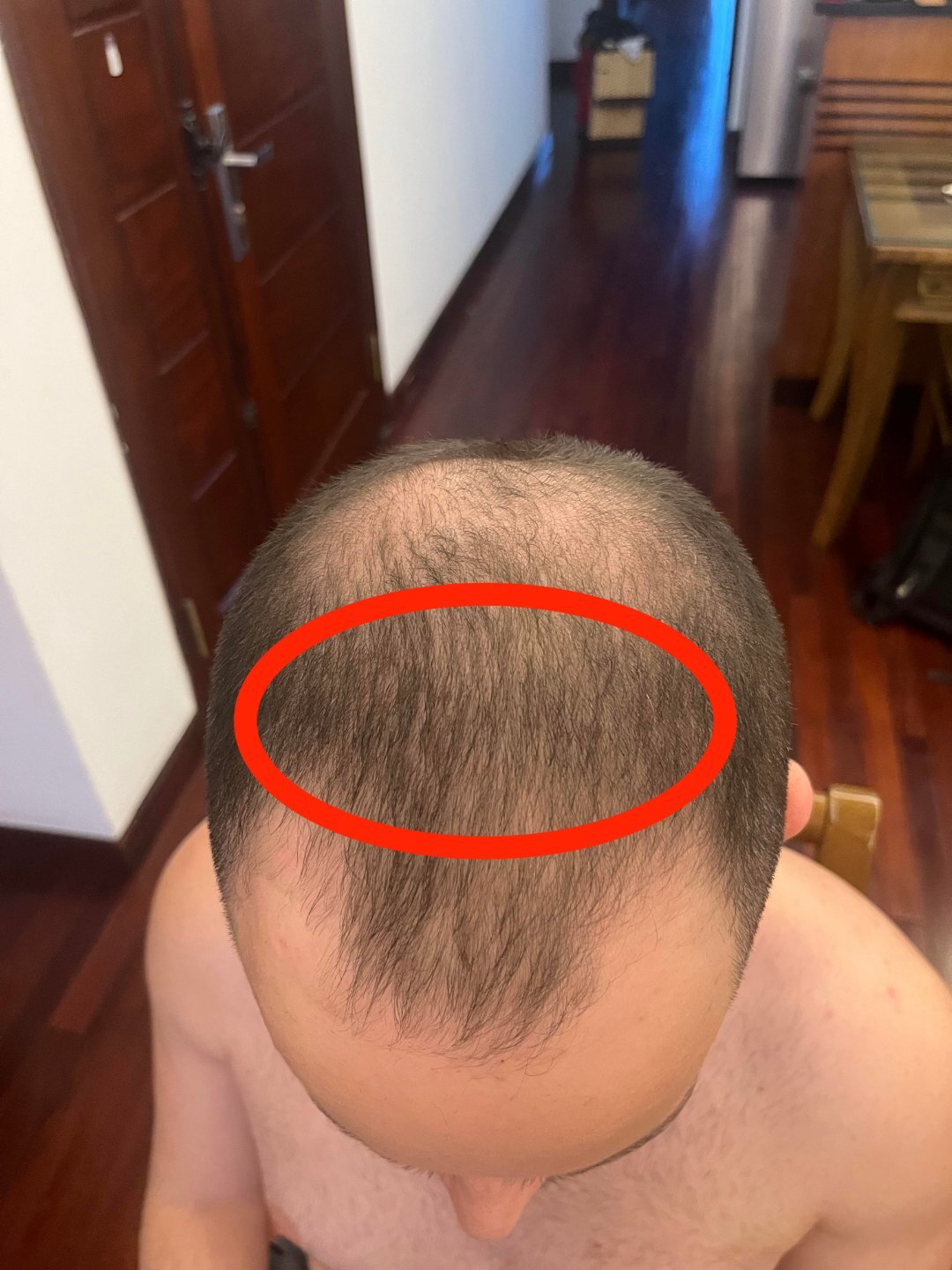 Do I need grafts on my mid scalp too? - Hair Restoration Questions and ...
