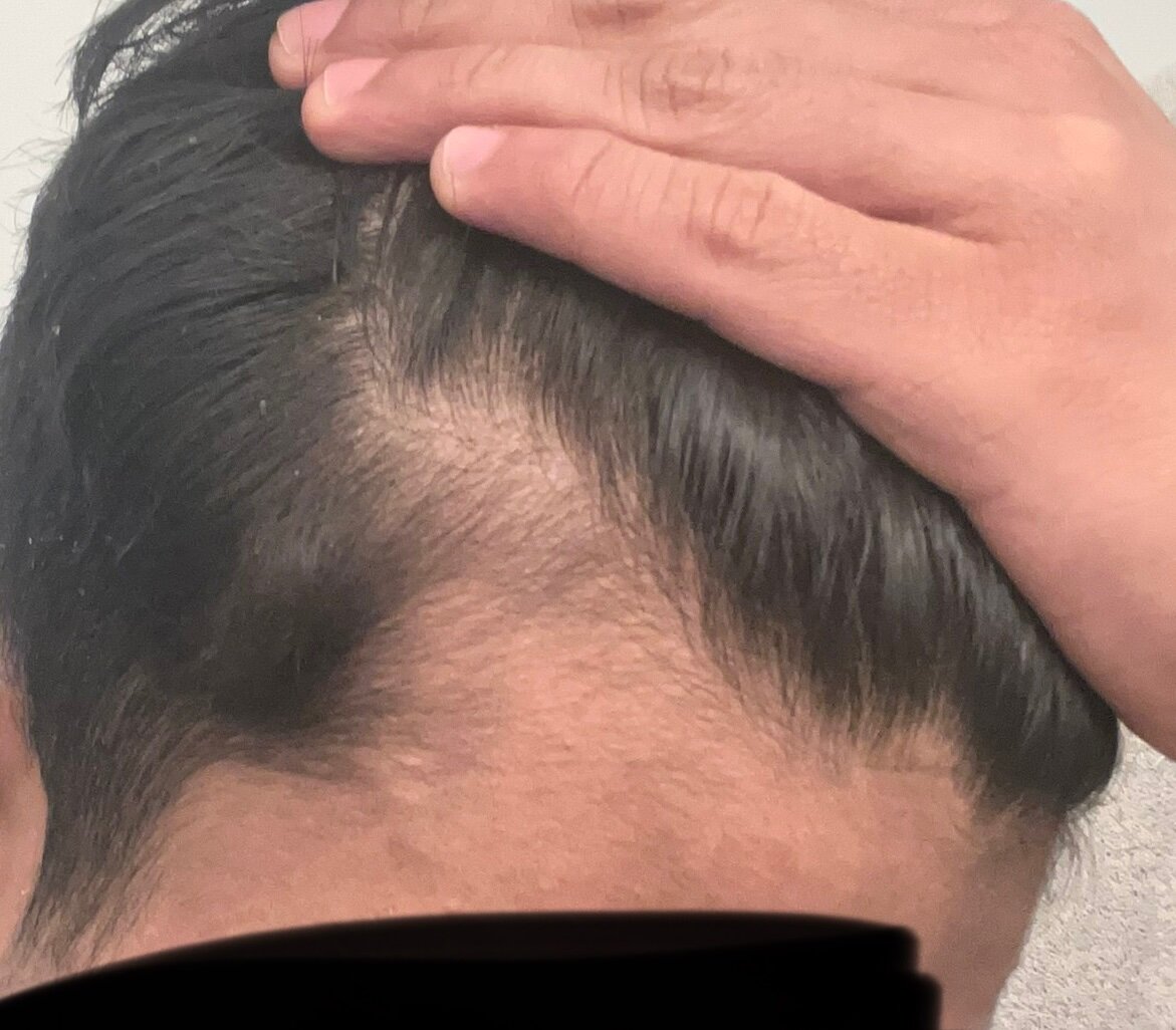 Is there too much overlap with native hair? - Hair Restoration ...