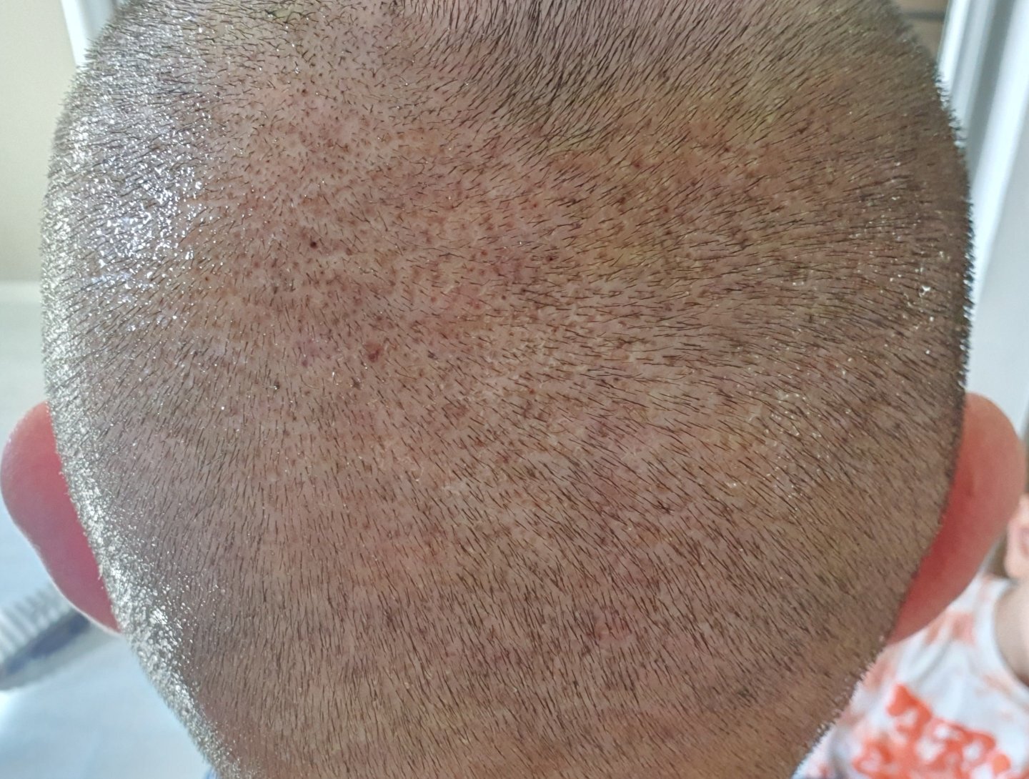 Which is the best in price range of $3000 ? - Hair Restoration ...