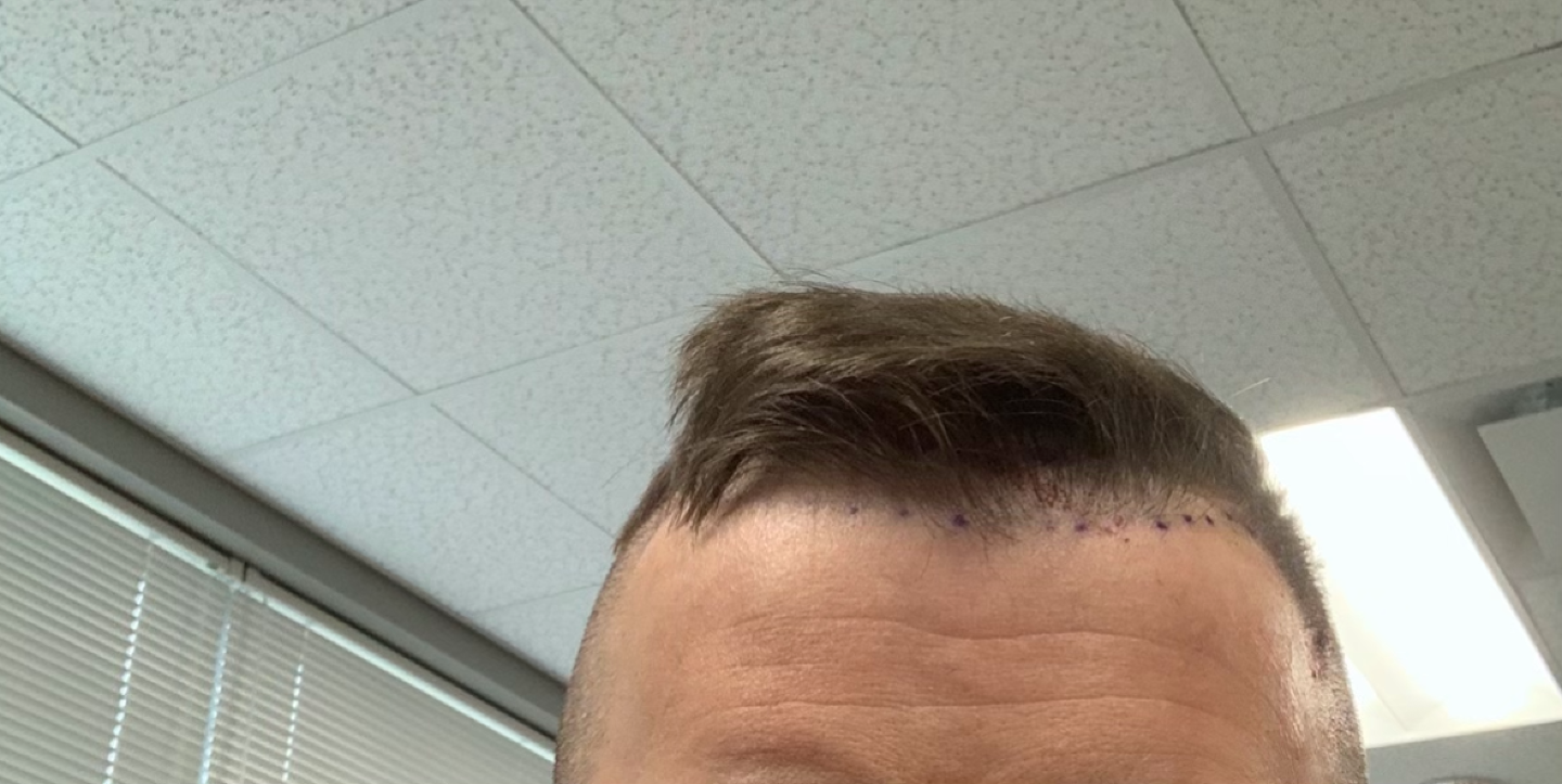 1000 grafts FUE Dr. Cooley - Hair Transplant Reviews - Hair Restoration ...