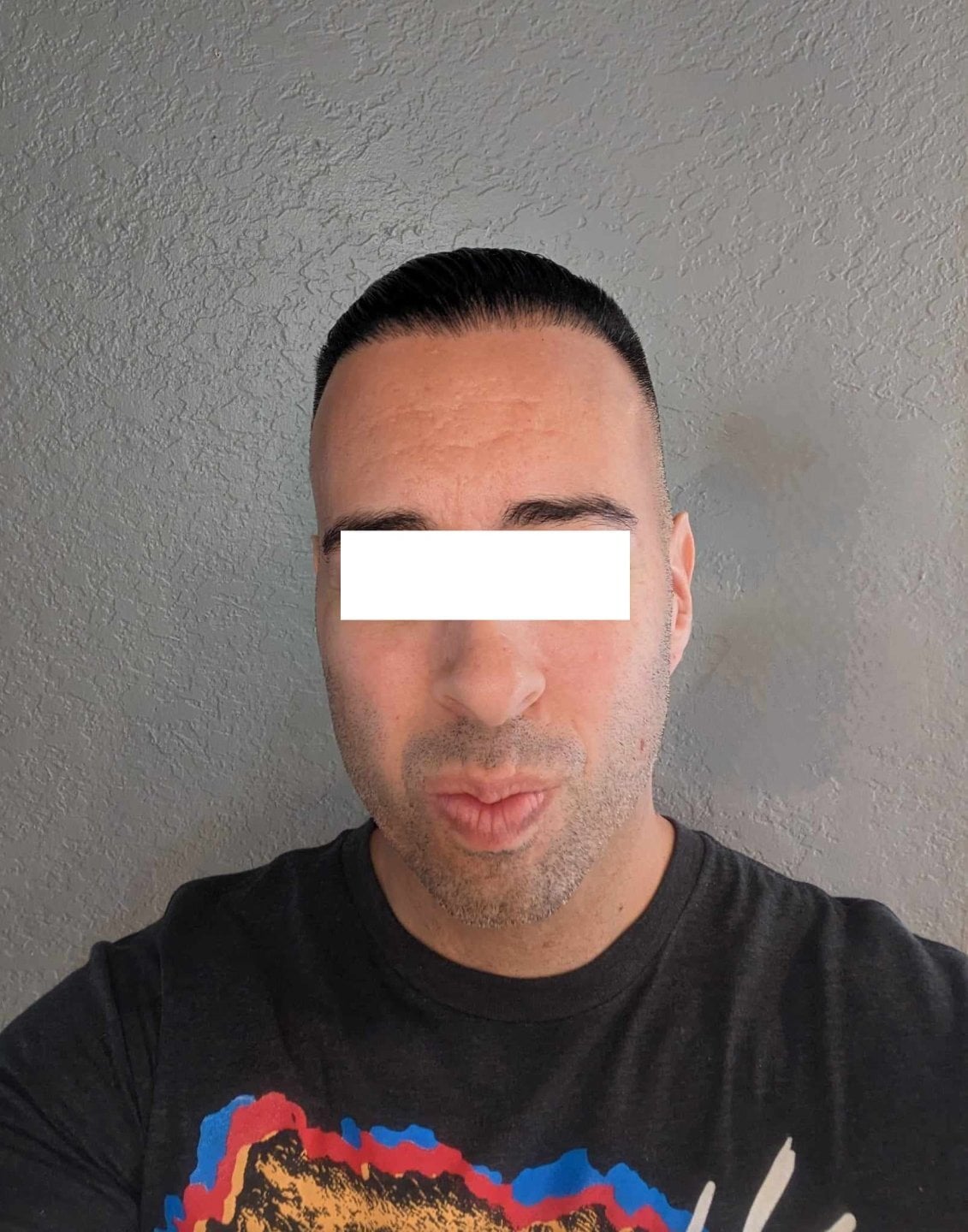 Is it worth getting my temporal peaks done if... - Hair Restoration ...