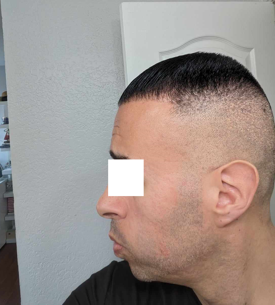 Is it worth getting my temporal peaks done if... - Hair Restoration ...