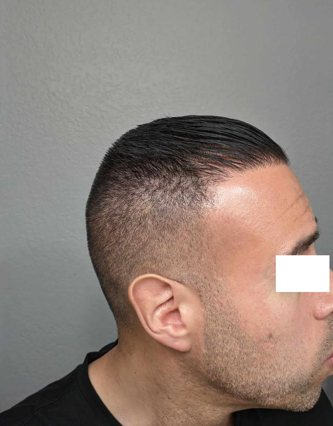 Is it worth getting my temporal peaks done if... - Hair Restoration ...