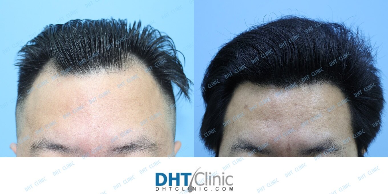Dr. Damkerng Pathomvanich (DHT Clinic) /Hairline FUE 1,910 grafts, 6 ...