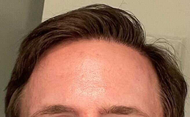 Can people post their hair transplants in direct sunlight - Hair ...