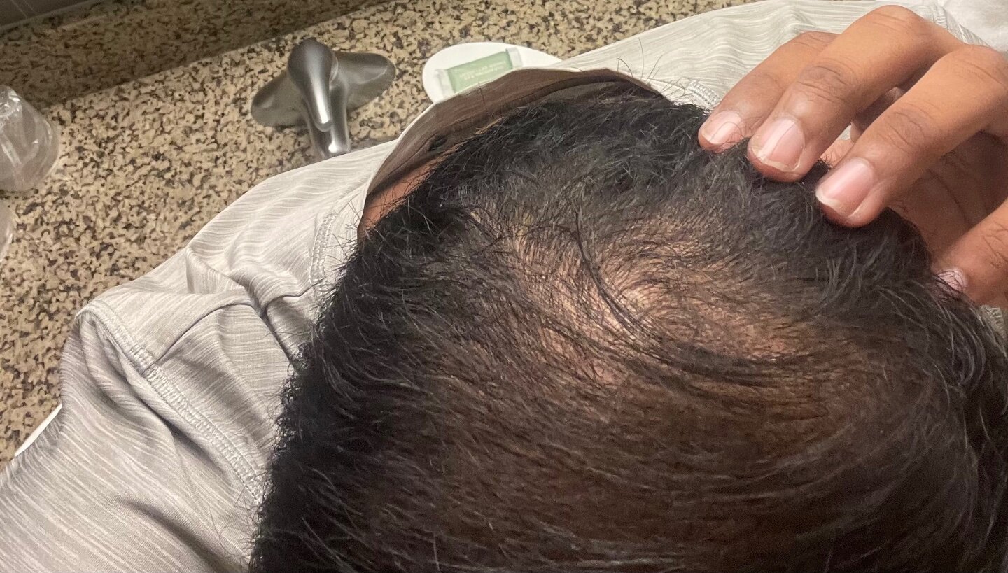 Hair transplant at Bosley - Hair Transplant Reviews - Hair Restoration ...