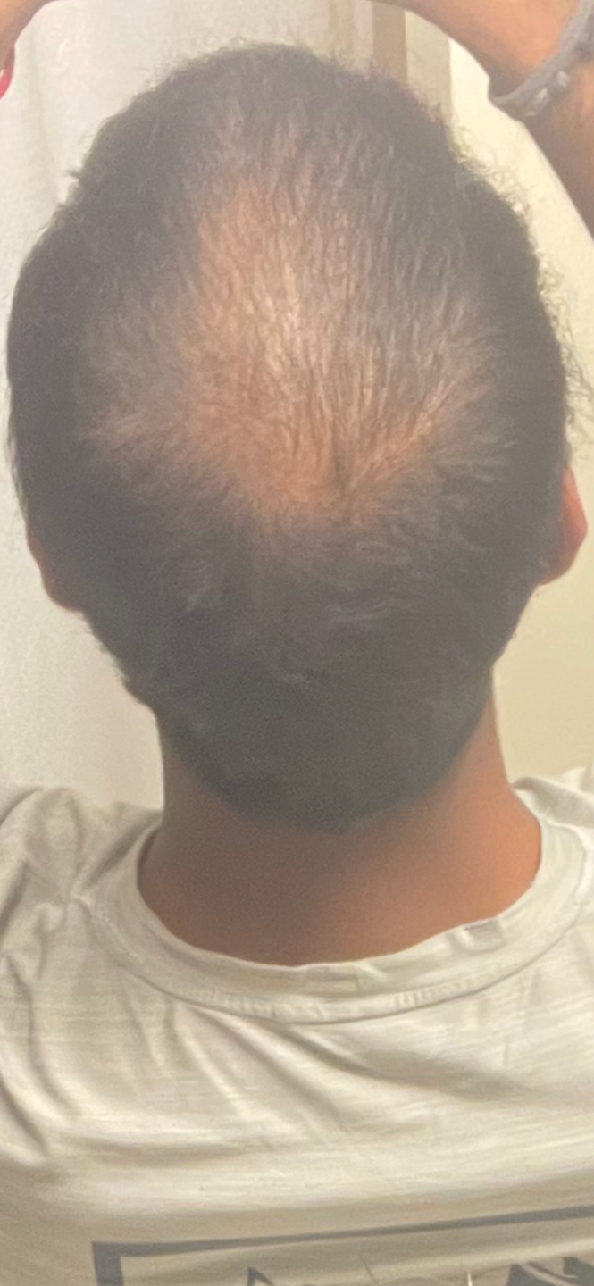 At risk of permanent shock loss? - Hair Restoration Questions and ...