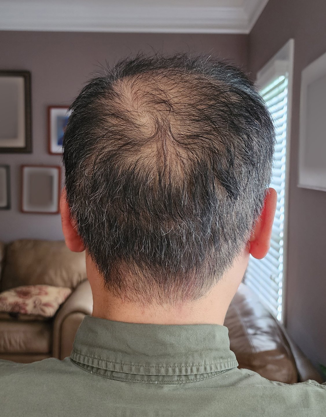 55-year-old male with NW 5/6. Am I a good candidate for hair transplant ...