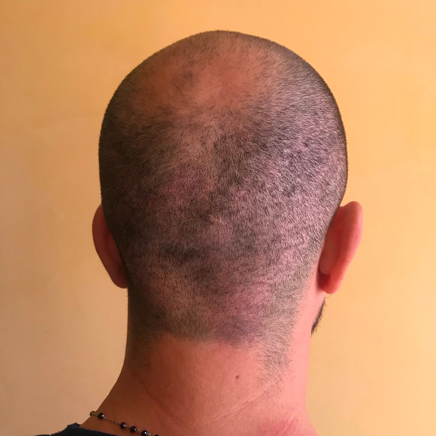 Shaving slick bald after FUE - Hair Restoration Questions and Answers ...