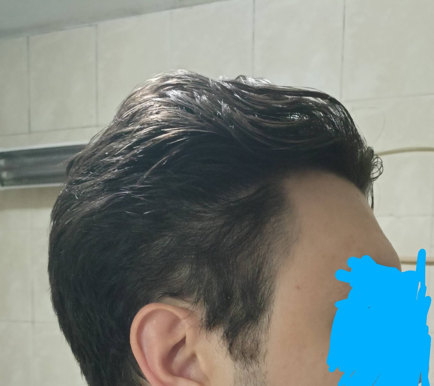 Temporal peaks design - Hair Restoration Questions and Answers - Hair ...