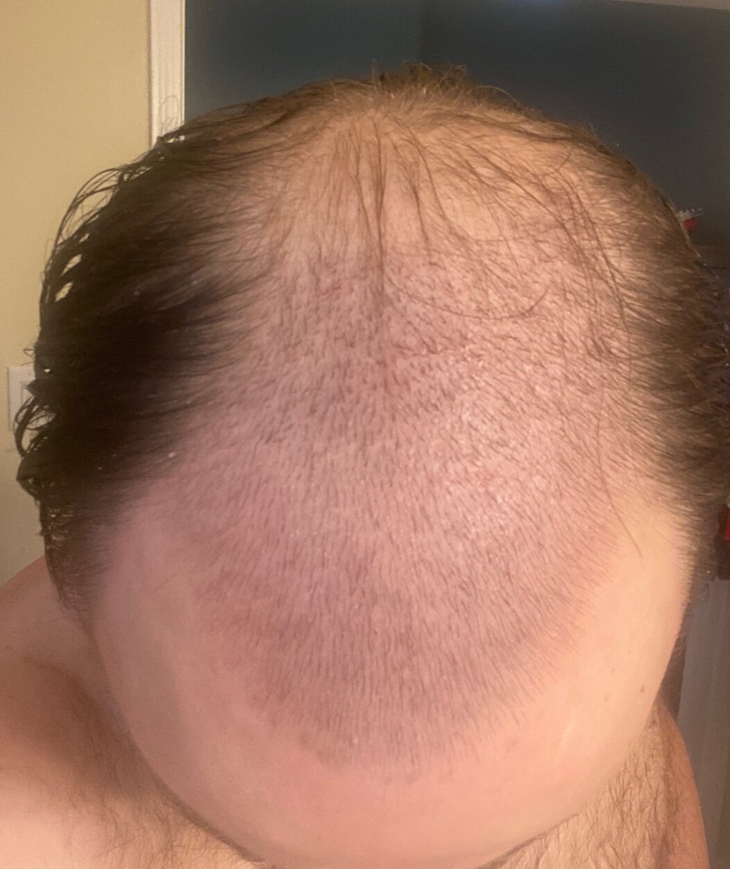3,092 FUT by Dr. Cooley - Hair Transplant Reviews - Hair Restoration ...