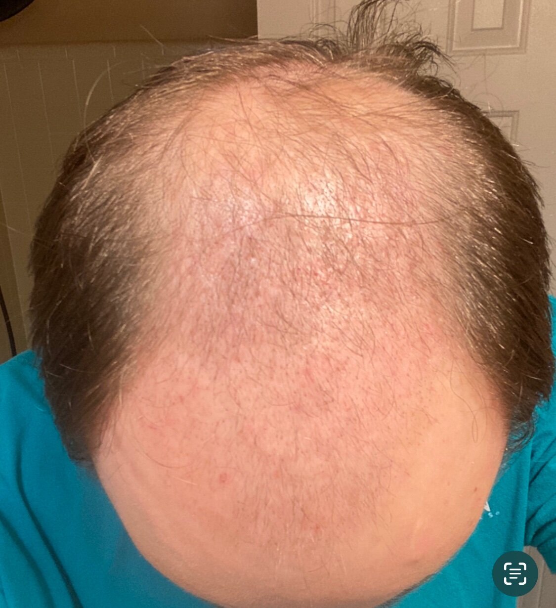 3,092 FUT by Dr. Cooley - Hair Transplant Reviews - Hair Restoration ...